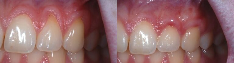 Soft Tissue Grafting Before and Afters | Metrolina Perio