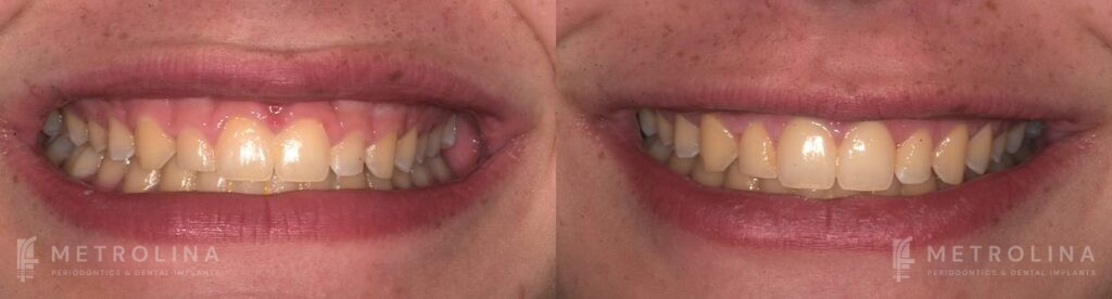 Crown Lengthening Before and Afters | Metrolina Perio